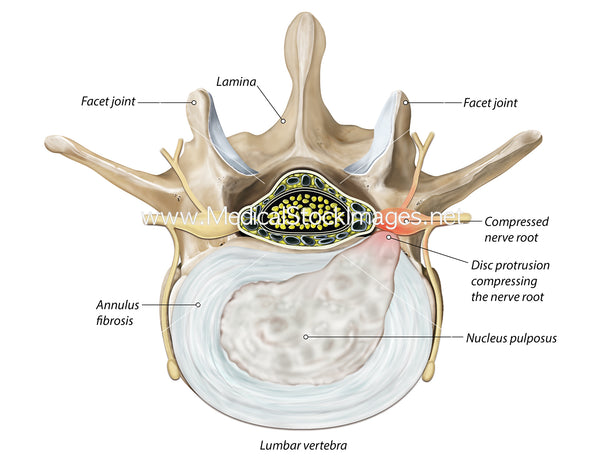 Cross Section View of Bulging Disc and Compressed nerve-Lumbar Region ...