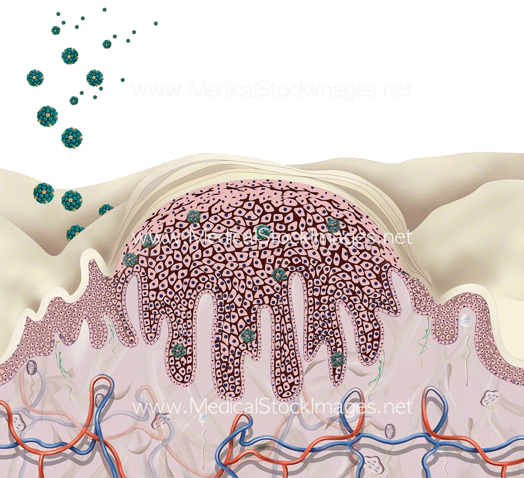 Anatomy Of A Plantar Wart Anatomy Drawing Diagram