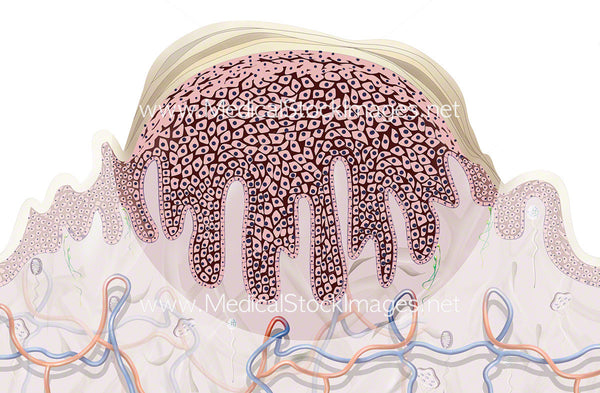 Anatomy of a Common Wart Illustration | Medical Stock – Medical Stock ...