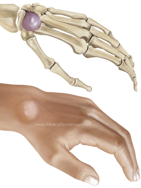 Ganglion cyst – Medical Stock Images Company