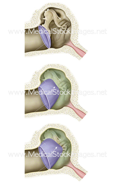Tympanic Membrane Retraction Stages (Middle Ear Atelectasis) – Medical ...