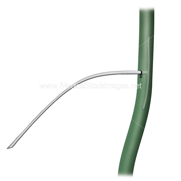 T-Tube used in Gallbladder Surgery – Medical Stock Images Company