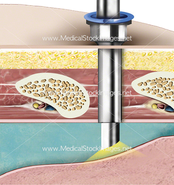 Close up Thoracoscopy Telescope in the Pleural Space – Medical Stock ...