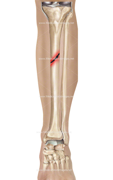 Tibia Fracture with Leg – Medical Stock Images Company