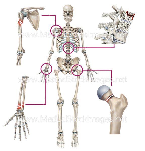 Fractures to Various Parts of the Skeleton – Medical Stock Images Company