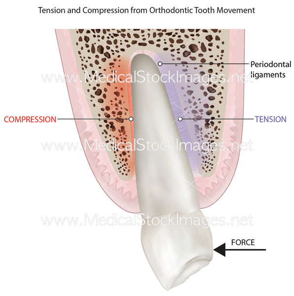 Tension and Compression from Orthodontic Tooth Movement – Medical Stock ...