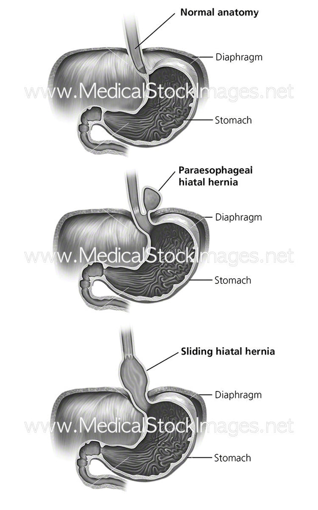 Hiatal Hernia Types