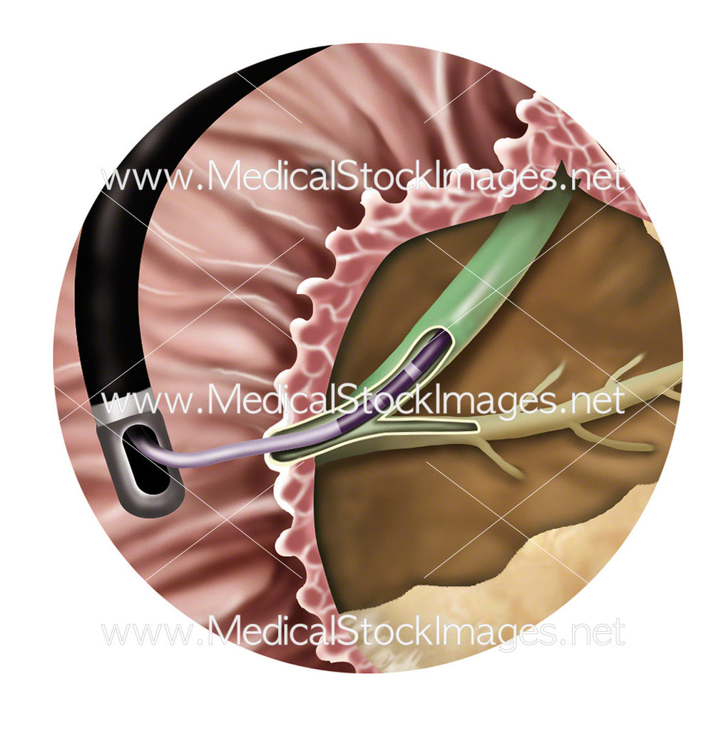Endoscopic Retrograde Cholangiopancreatography