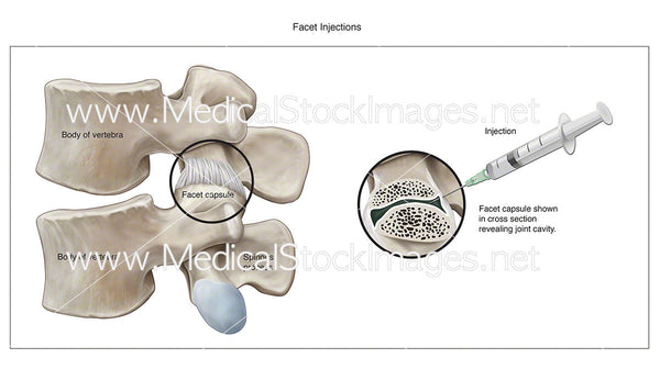 Facet Injections - Labelled – Medical Stock Images Company