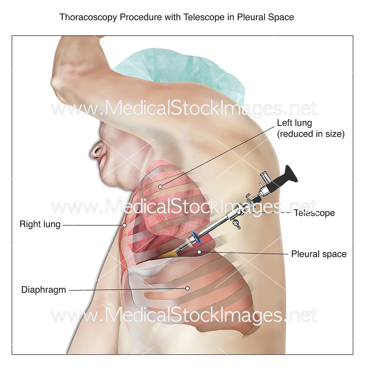 Thoracoscopy Procedure With Telescope In Pleural Space Medical Stock Images Company