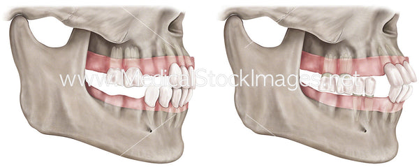 Dental Illustration Depicting Tooth Loss – Medical Stock Images Company